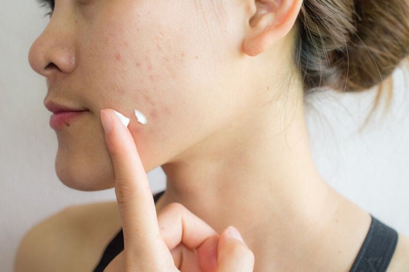 Acne-littekens: wat kan je doen? | Etos