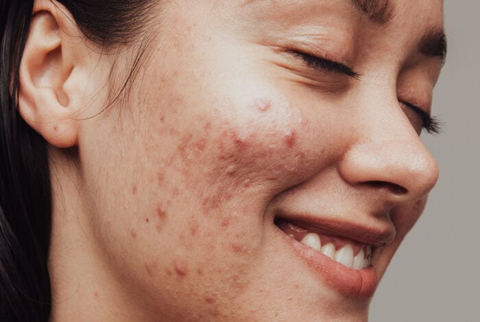 Wanneer leidt een huidschimmel tot een infectie? | Etos